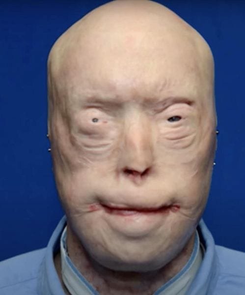 Firefighter has face transplant after third-degree burns & survives ...